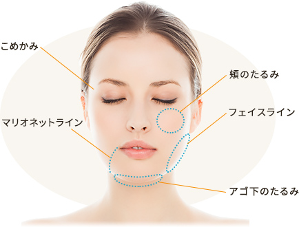 アンカーDXダブル | 若返り・アンチエイジング | 美容整形、美容外科、美容皮膚科なら聖心美容クリニック