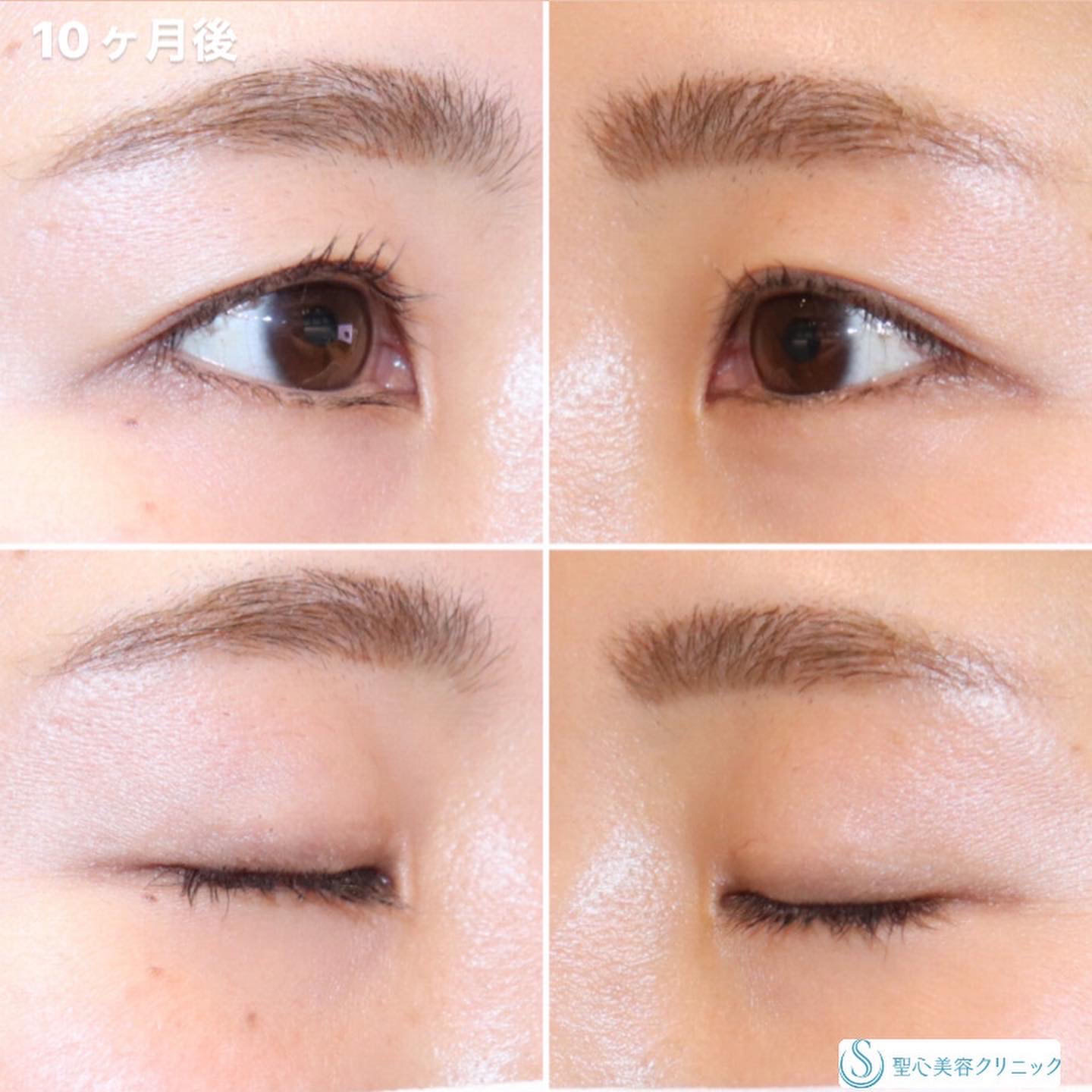 【20代女性・二重術（切開法）＋目上切開で平行型二重に】二重術（切開法）＋目上切開（術直後～術後10か月） - 症例写真 - 美容整形、美容 ...