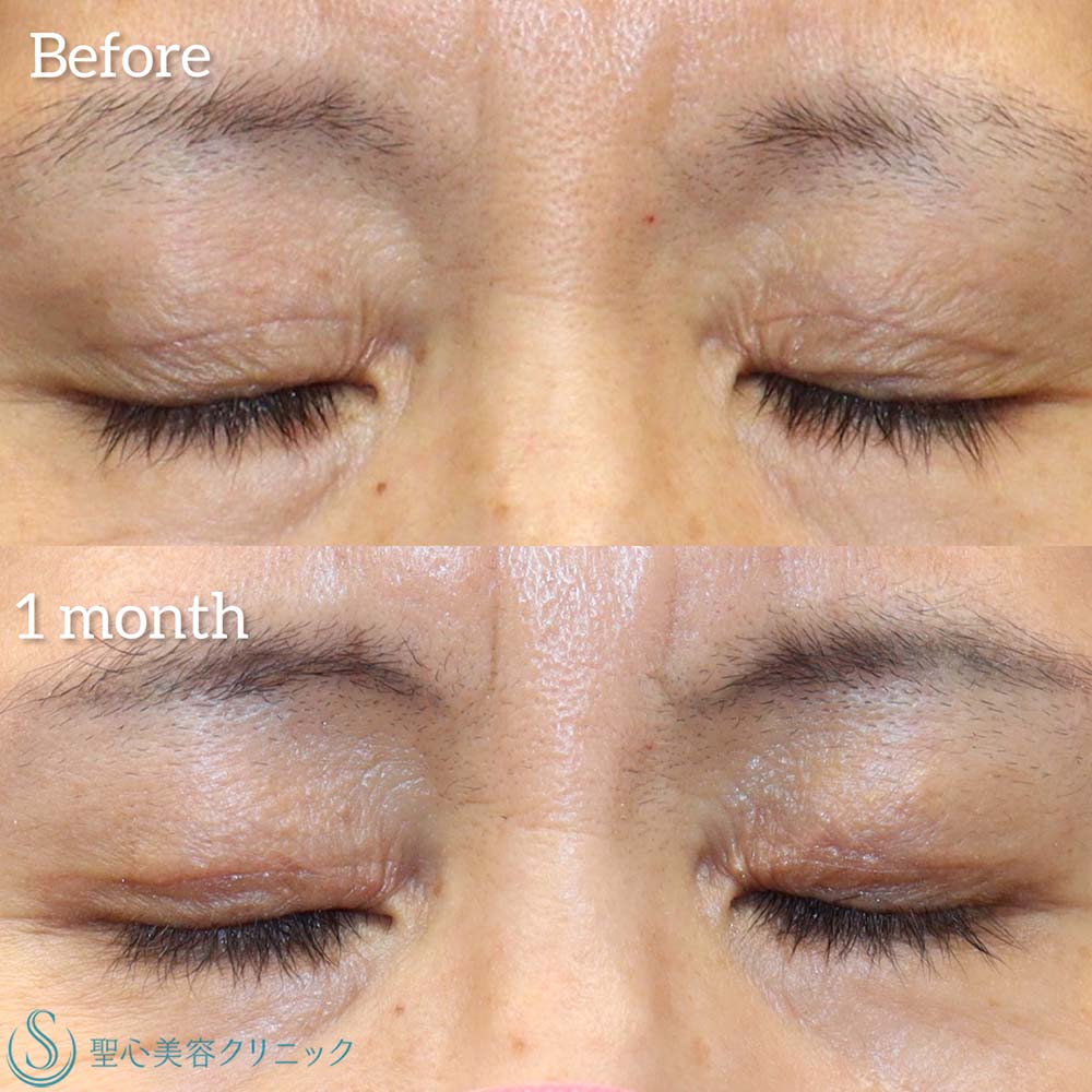 【60代女性・若さは目元から】眼瞼下垂症手術（1ヶ月後） - 症例写真 - 美容整形、美容外科なら聖心美容クリニック