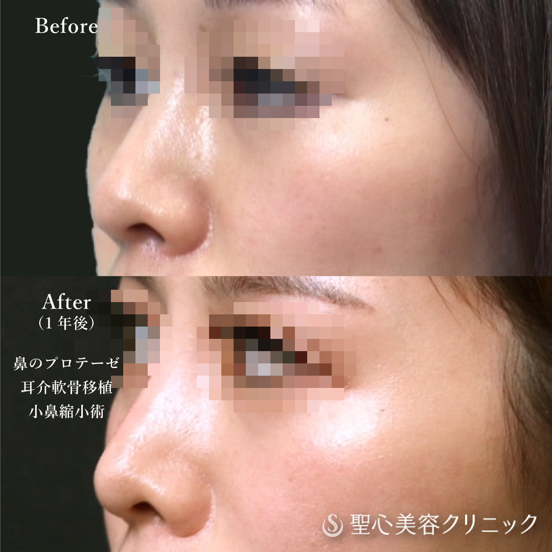 【20代女性・鼻筋をスッキリ】プロテーゼによる隆鼻術・鼻尖形成（耳介軟骨移植）・ 小鼻縮小（1年後） 症例写真 美容整形、美容外科なら聖心美容クリニック