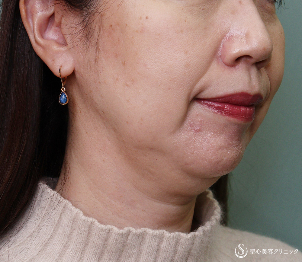 【50代女性・あご下のボリューム】FatX（ファットエックス）脂肪溶解注射（治療開始後4か月） - 症例写真 - 美容整形、美容外科なら聖心 ...