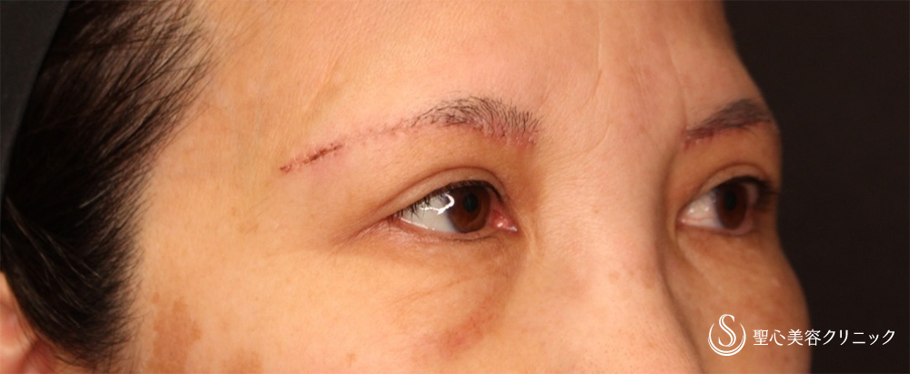 【50代女性・まぶたのたるみ】眉下切開法（術後7日） - 症例写真 - 美容整形、美容外科なら聖心美容クリニック